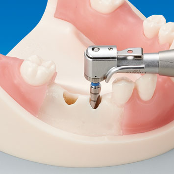 Implant Area | Implant Practice Jaw Model [IMP1005-L-SP]