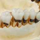 Periodontal Surgery Area | Periodontal Jaw Model [PER1001-UL-SP-FEM-32 ...