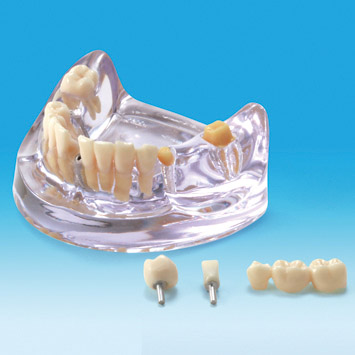 IMPLANTS (IMP) | IMPLANT MODEL [PE-IMP003]